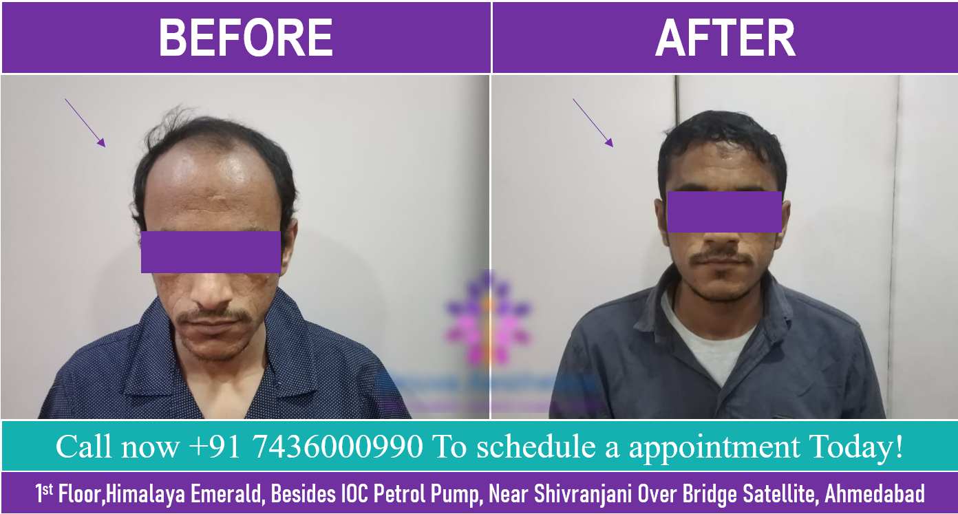 29 Year Old Patients Hair Transplant Clinic In Ahmedabad Testimonial