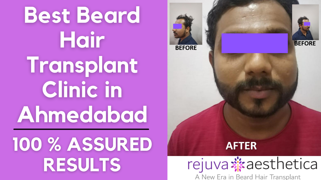 Beard Hair Transplant In Ahmedabad By Plastic Surgeon Dr Arth Shah